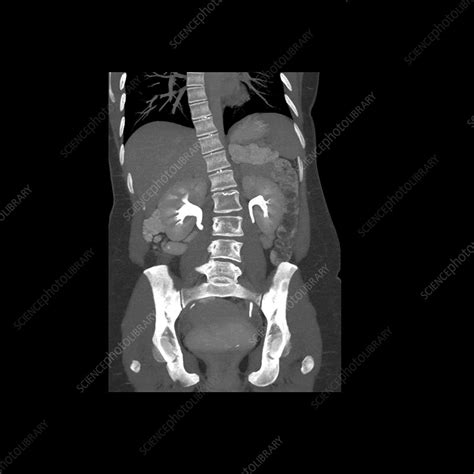 Thoracolumbar Scoliosis Stock Image M2600417 Science Photo Library
