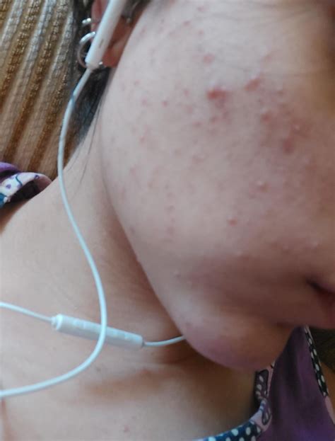 Is This Fungal Acne Or Not Rfungalacne