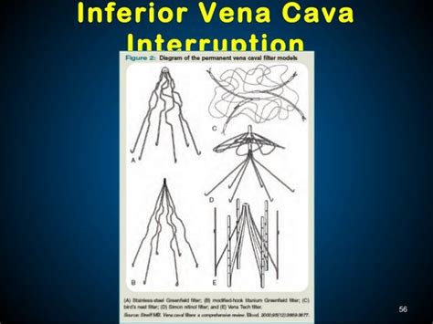 18 Best Interrupted Inferior Vena Cava Ivc Images On Pinterest