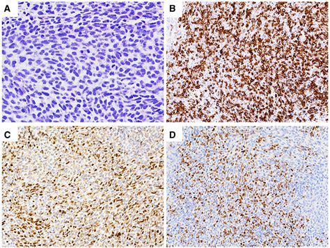 Embryonal Rhabdomyosarcoma In A Patient With A Germline Cbl Pathogenic Variant Abstract