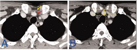 Computed Tomography Ct Scans Of The Thoracic Inlet A Anatomical Download Scientific
