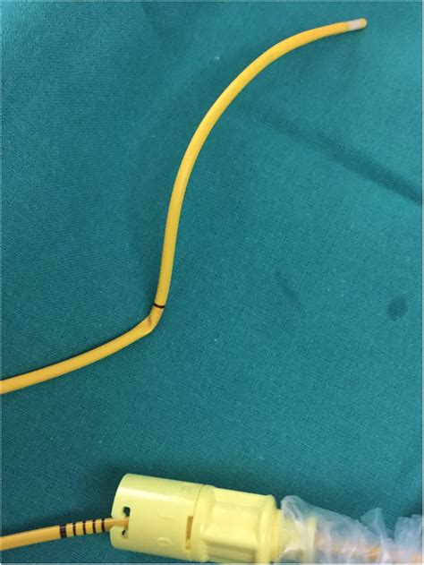 Difficult Removal Of A Kinked Swan Ganz Catheter Journal Of
