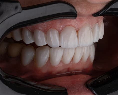 Medication Free And Surgery Free Treatments For Tmj Disorder — Dr