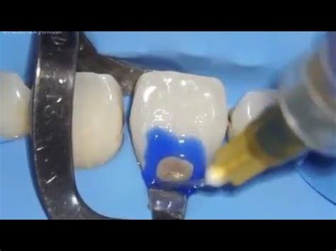 Class V Composite Restoration Direct Anterior Composite Restoration