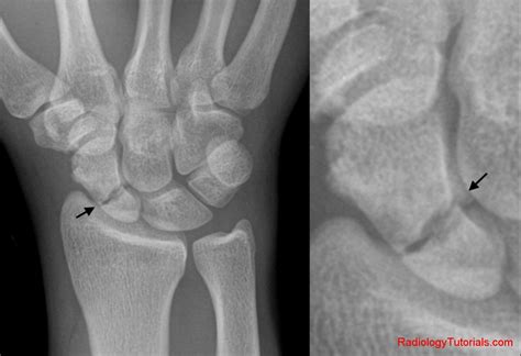 주상골 골절scaphoid Bone Fracture Bs손해사정