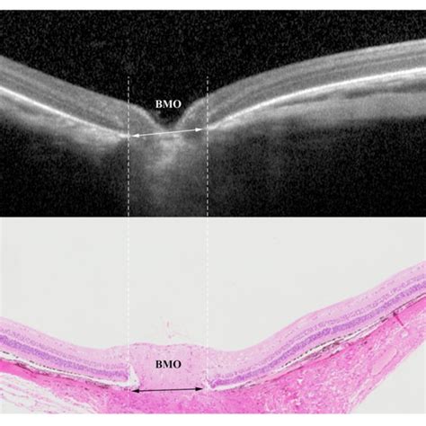 Optical Coherence Tomographic Image Enhanced Depth Imaging Mode A