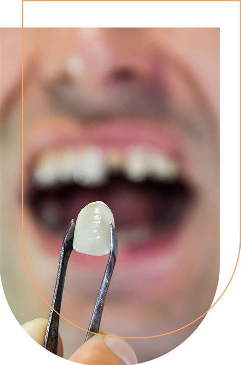 Broken Teeth Mend Dental