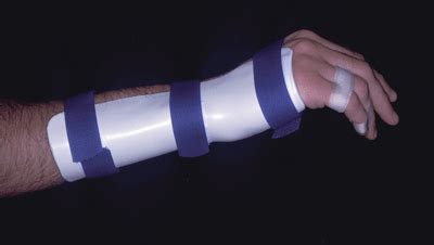 Why I Dislike Ulnar Radial Gutter Splints HandLab Resources