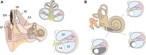Ultra High Resolution Ct To Detect Intracochlear New Bone Formation After Cochlear Implantation