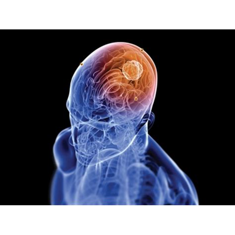 Bone Fiducial Markers Gamma Gurus