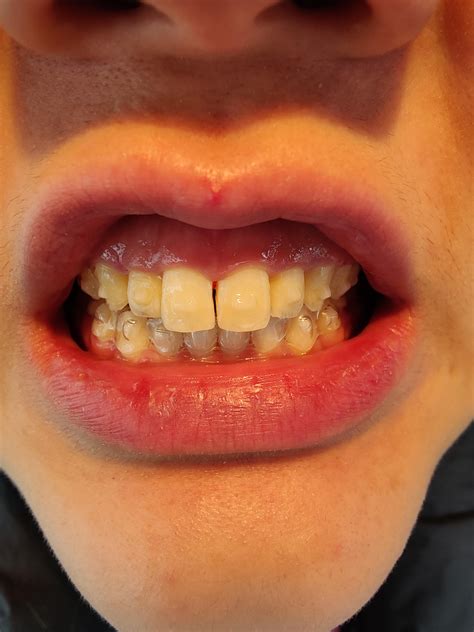 Dentist Messed Up On Ipr Story In Comments R Invisalign
