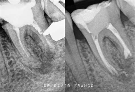 Endodoncia Beniaján en Clínica dental LA FUENSANTA Beniaján Murcia