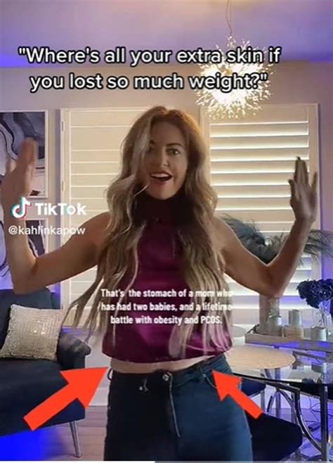 Experts Warn Ozempic Is Causing Wave Of Plastic Surgeries To Fix Loose