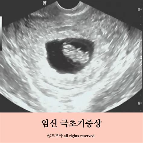 임신 극초기증상 아랫배 가슴통증 두통감기 설사 변비 입덧시기 언제부터 네이버 블로그