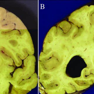 A Coronal Section Of Lm S Brain With More Mature Appearing Initial