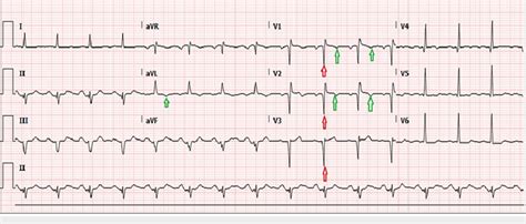 Ekg During Follow Up Showing Pathological Q Waves Red Arrow And