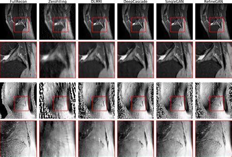 Compressed Sensing Mri Reconstruction Using A Generative Adversarial Network With A Cyclic Loss