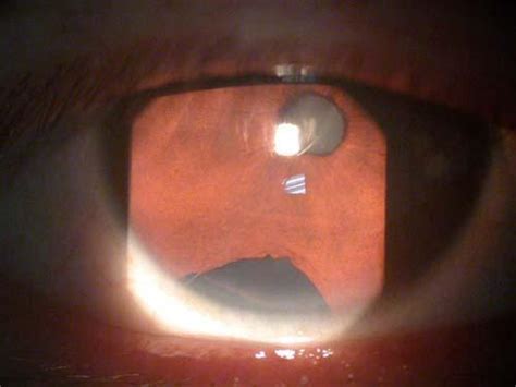 Eye Injury Treatment Eye Trauma Abrasion Treatment