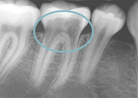 Understanding Tooth Resorption Eleven Eleven Dental Port Angeles Dentist Near Me