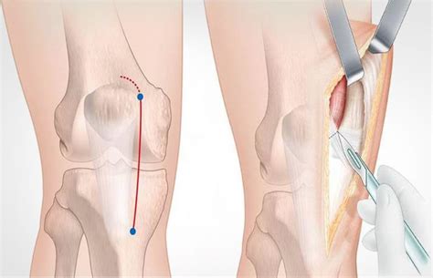 Achievements Dr Santosh Shetty Robotic Knee Replacement Surgeon Mumbai