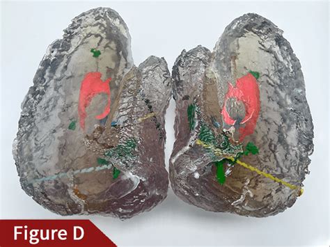 Periventricular Nodular Heterotopia Pvnh 3d And Quantitative