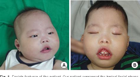 Alpha Thalassemia Mental Retardation Syndrome An Overview 42 Off
