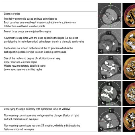 Variability And Heterogeneous Spectrum Of Bicuspid Aortic Valve