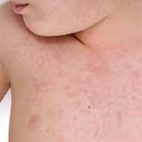 Contagious Viral Infection Test In Delhi Ncr India Gdic