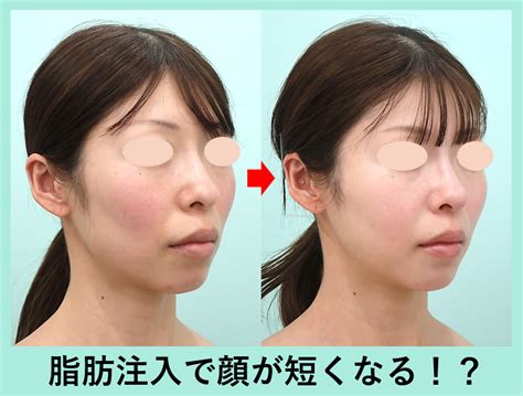 頬こけ脂肪注入 】頬骨の浮き出しを改善させ、面長感を解消させる Womクリニック銀座