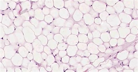 Adipose Tissue As An Endocrine Immune Organ In Hiv Associated Lipodystrophy