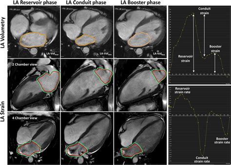 Measurement Of Left Atrial Longitudinal Strain And Strain Rate In A