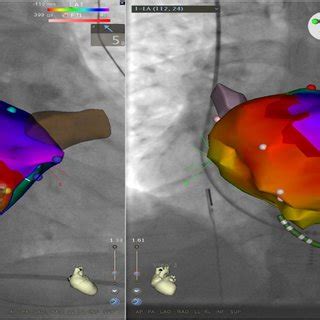 Risk Factors And Management Of Mitral Annular Atrial Flutter After Mitral Valve Surgery