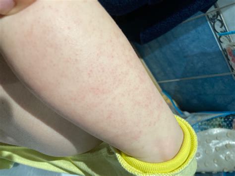 Покраснения у ребенка Вопрос детскому дерматологу 03 Онлайн