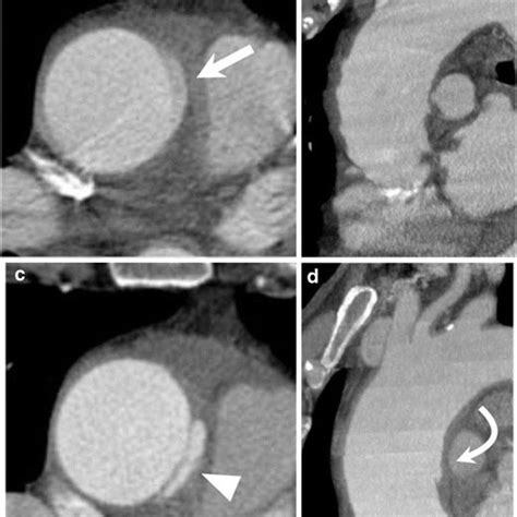 impact of ecg gated ct angiography cta non gated a b and