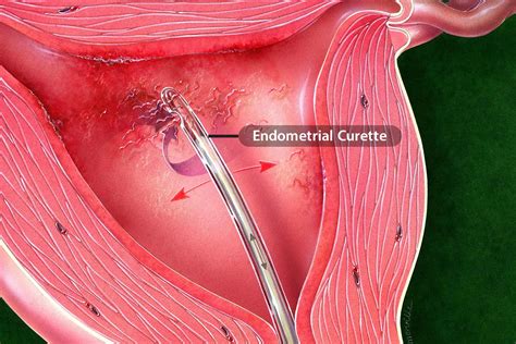 Endometrium Discharge