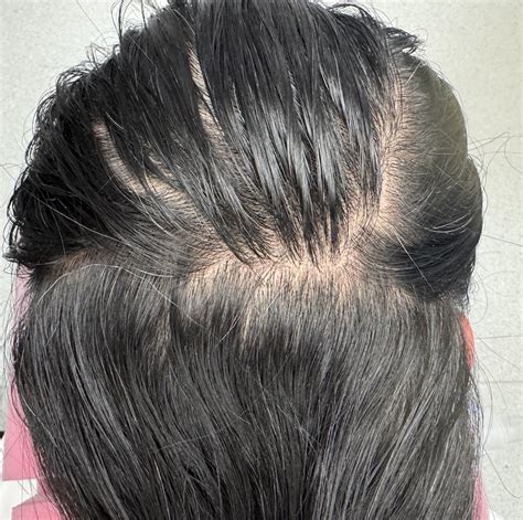 Scalp Tissue Expander Incision Healing Dr Barry Eppley Explore Plastic Surgery