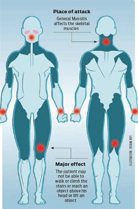 What Is Myositis Know Its Symptoms And Dietary Lifestyle Modification