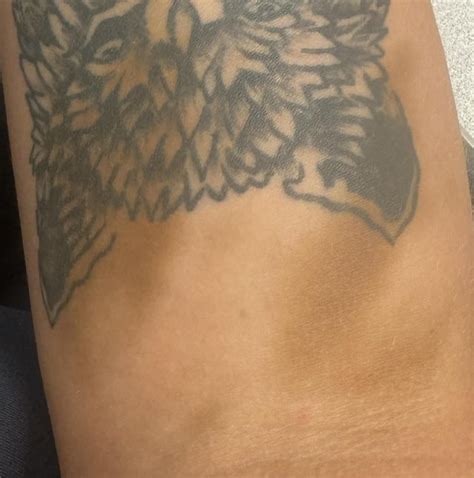 Iv Staining R Anemic