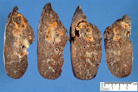 Cystic Fibrosis Lungs Vs Healthy Lungs