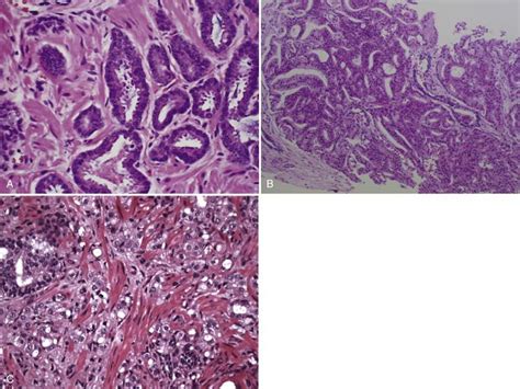 Molecular Basis Of Prostate Cancer Clinical Tree