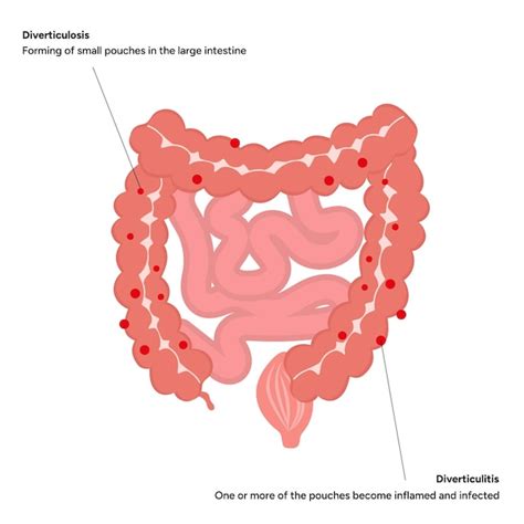 Premium Vector Ulcerative Colitis