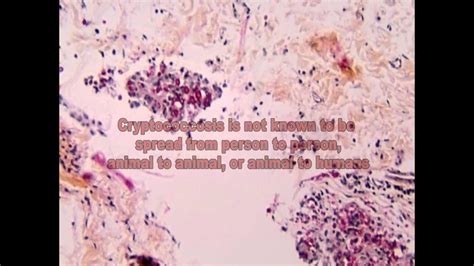 Cryptococcus Gram Stain