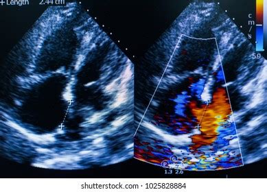 Color Doppler Flow Imaging Human Stock Photos Images Photography Shutterstock