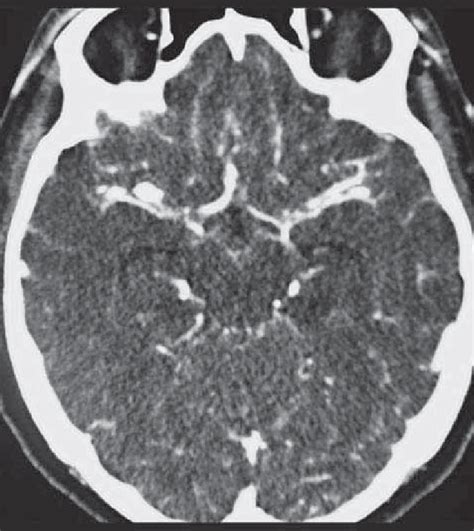 Ct Angiogram Demonstrates An Aneurysm Maximum Diameter 6 Mm Neck 3 Download Scientific