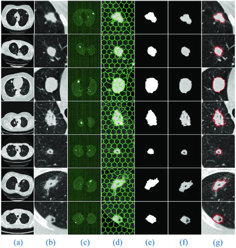 the segmentation results of our method for solitary pulmonary nodules