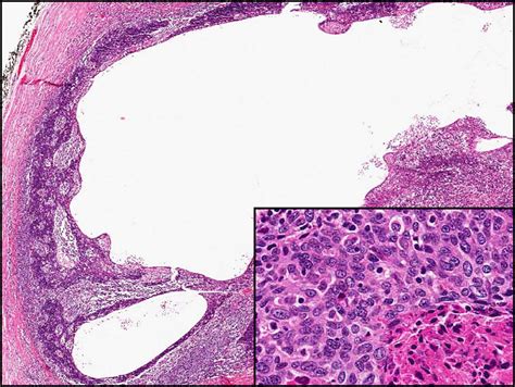 Branchial Cleft Cyst Histology