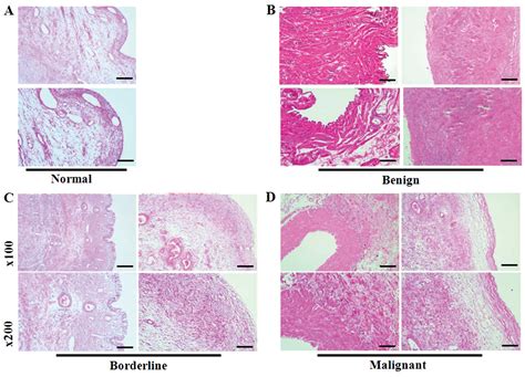 Serous Epithelial Ovarian Cancer Cancerwalls