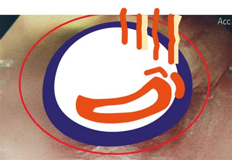 他突大黑便！醫一照「食道癌第二期」 6大警訊曝光 Ettoday健康雲 Ettoday新聞雲