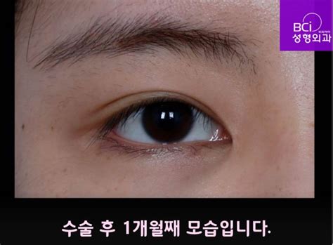 쌍꺼풀재수술비용 보기에도 실제로도 편안해져 네이버 블로그