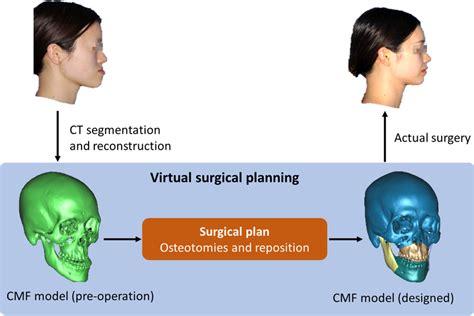 Vsp Procedures For Orthognathic Surgery Before Surgery Patients